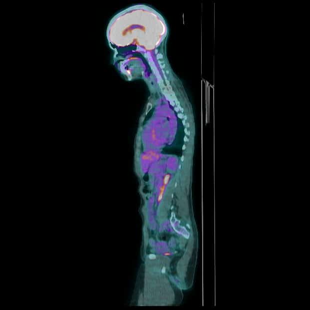 Présentation TEP Scan - Scintigraphie Tep Nancy